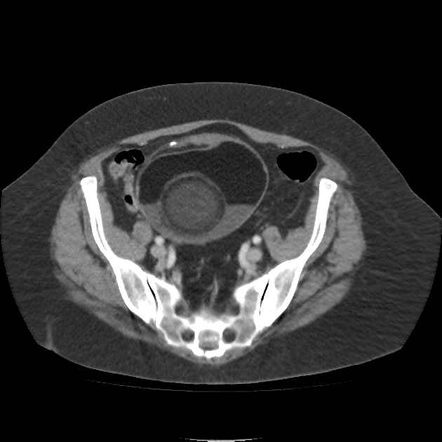 Laparoskopija - dermoidna cista - Palmotićeva - Ginekološka Bolnica